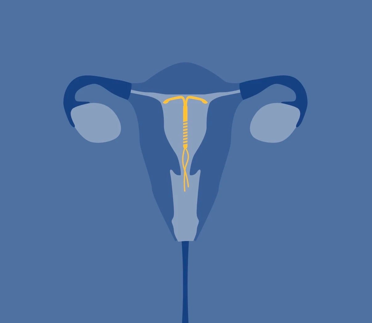 Anticonceptivos Intrauterinos DIU - Farmati – Farmati.cl